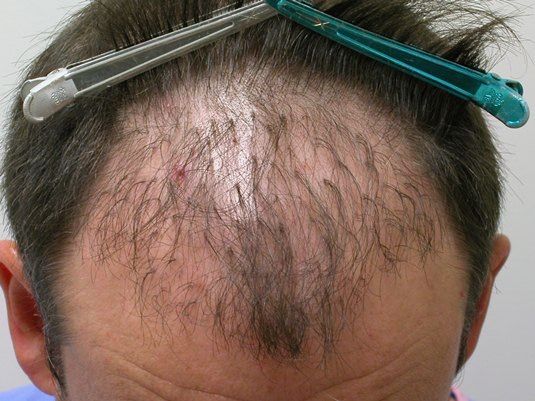 Bad Hair Transplant examples | Hair loss Forum - Hair Transplant forums