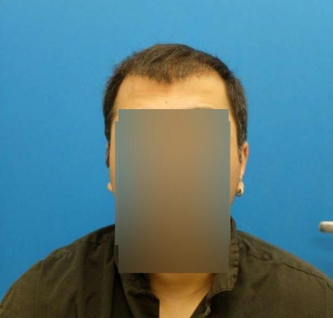 My experience of surgery with Dr Wong of Hasson and Wong | Hair loss ...