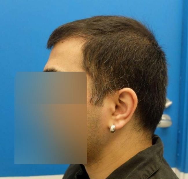 My experience of surgery with Dr Wong of Hasson and Wong | Hair loss ...